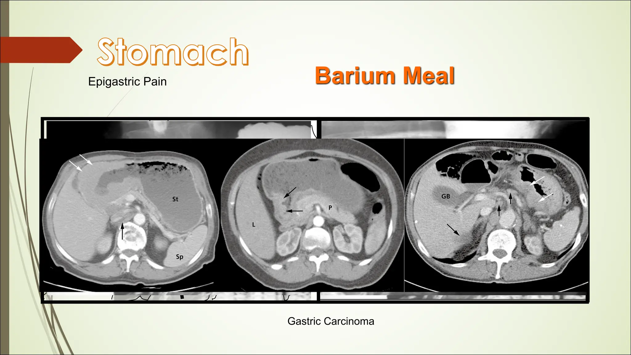 13 Radiology Diseases Of Gastrointestinal Tract Pdf