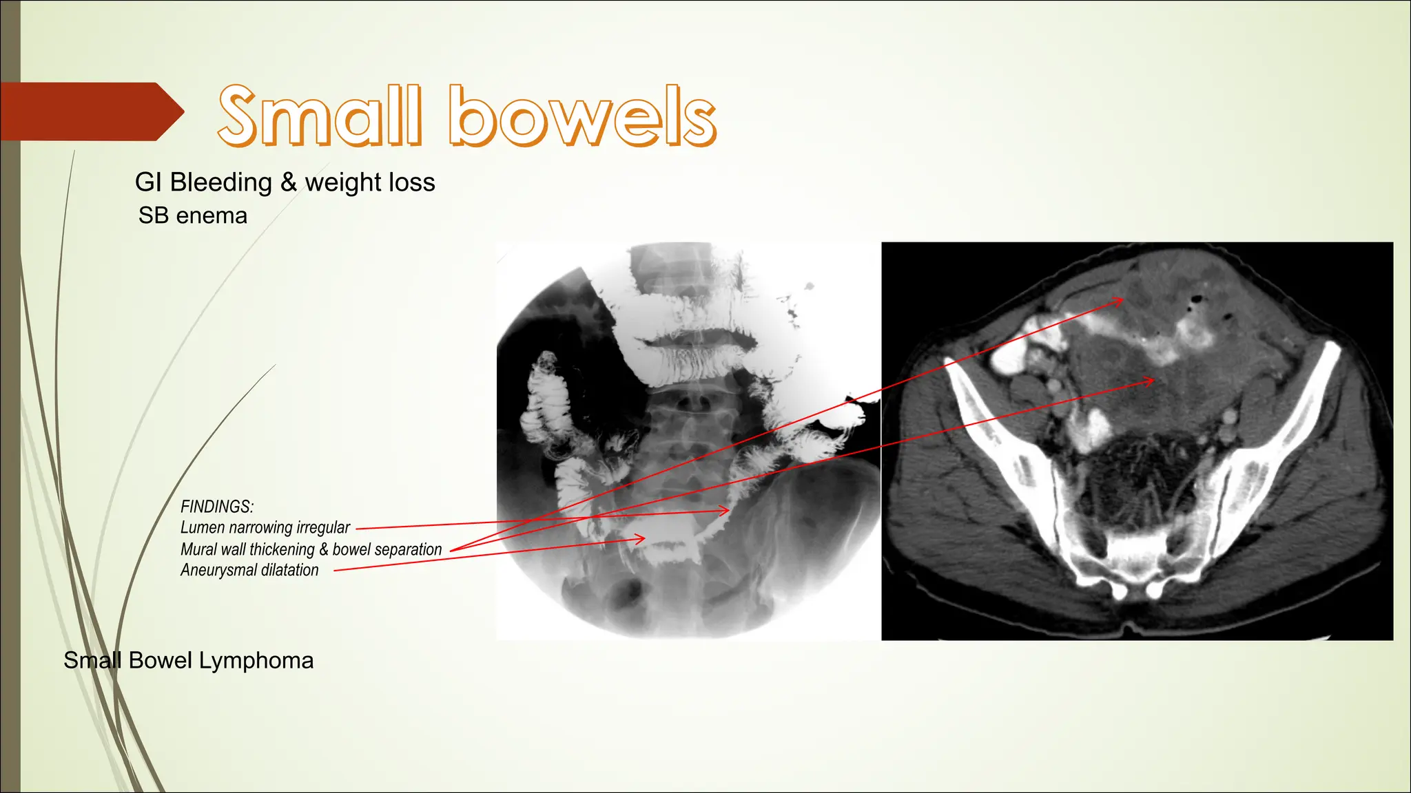 13- RADIOLOGY DISEASES OF GASTROINTESTINAL TRACT.pdf
