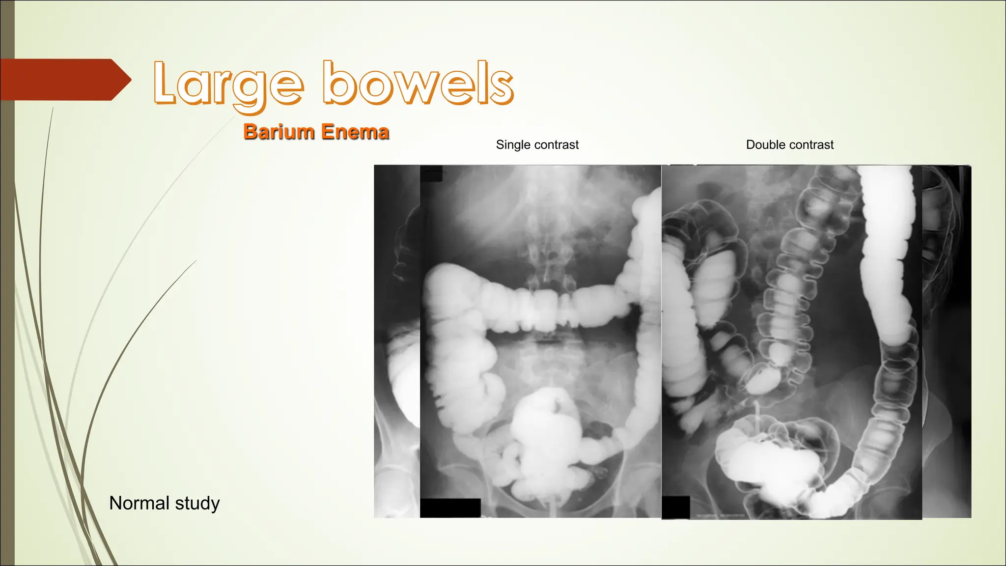 13 Radiology Diseases Of Gastrointestinal Tract Pdf
