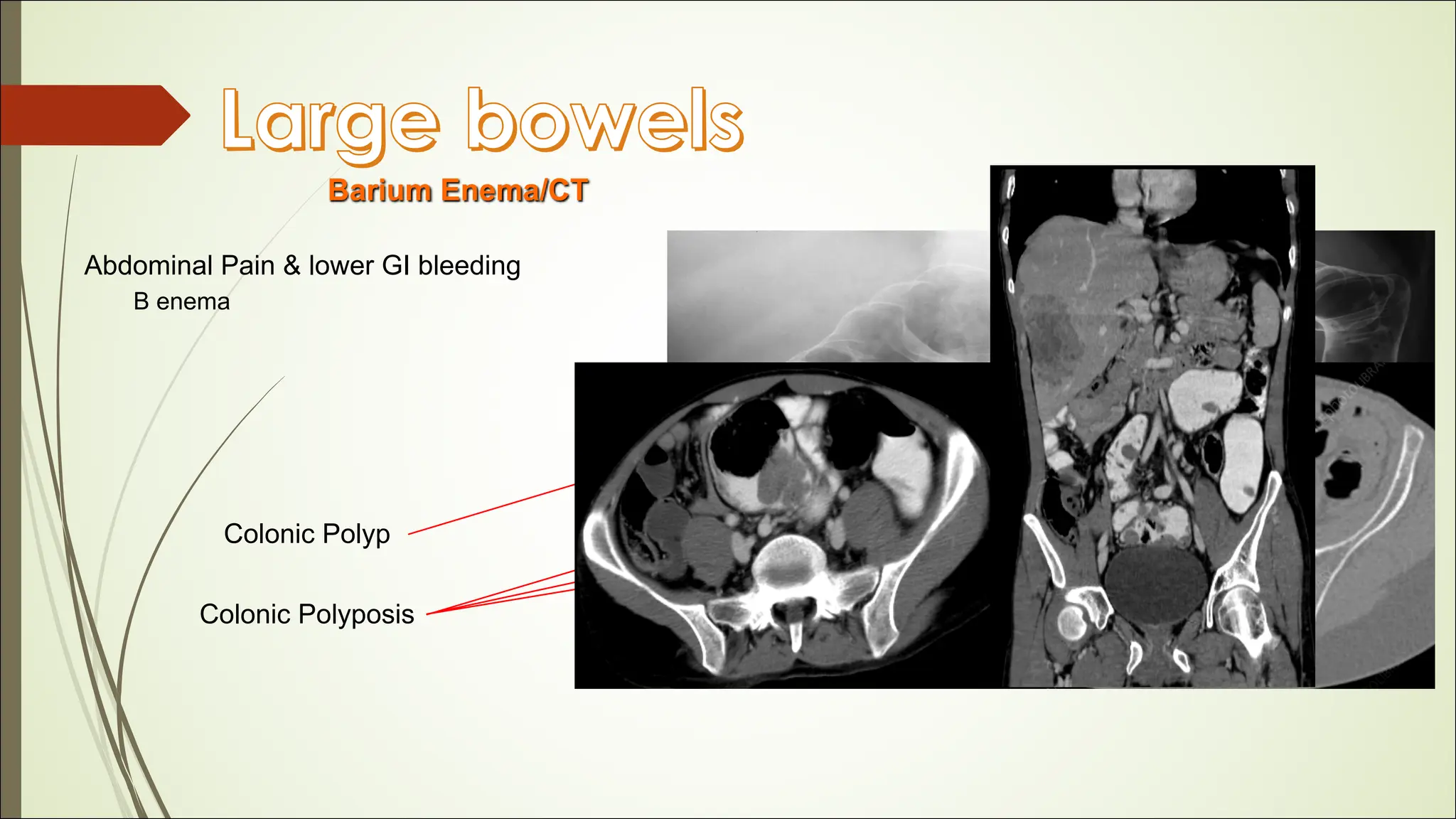 13 Radiology Diseases Of Gastrointestinal Tract Pdf