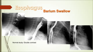 13- RADIOLOGY DISEASES OF GASTROINTESTINAL TRACT.pdf