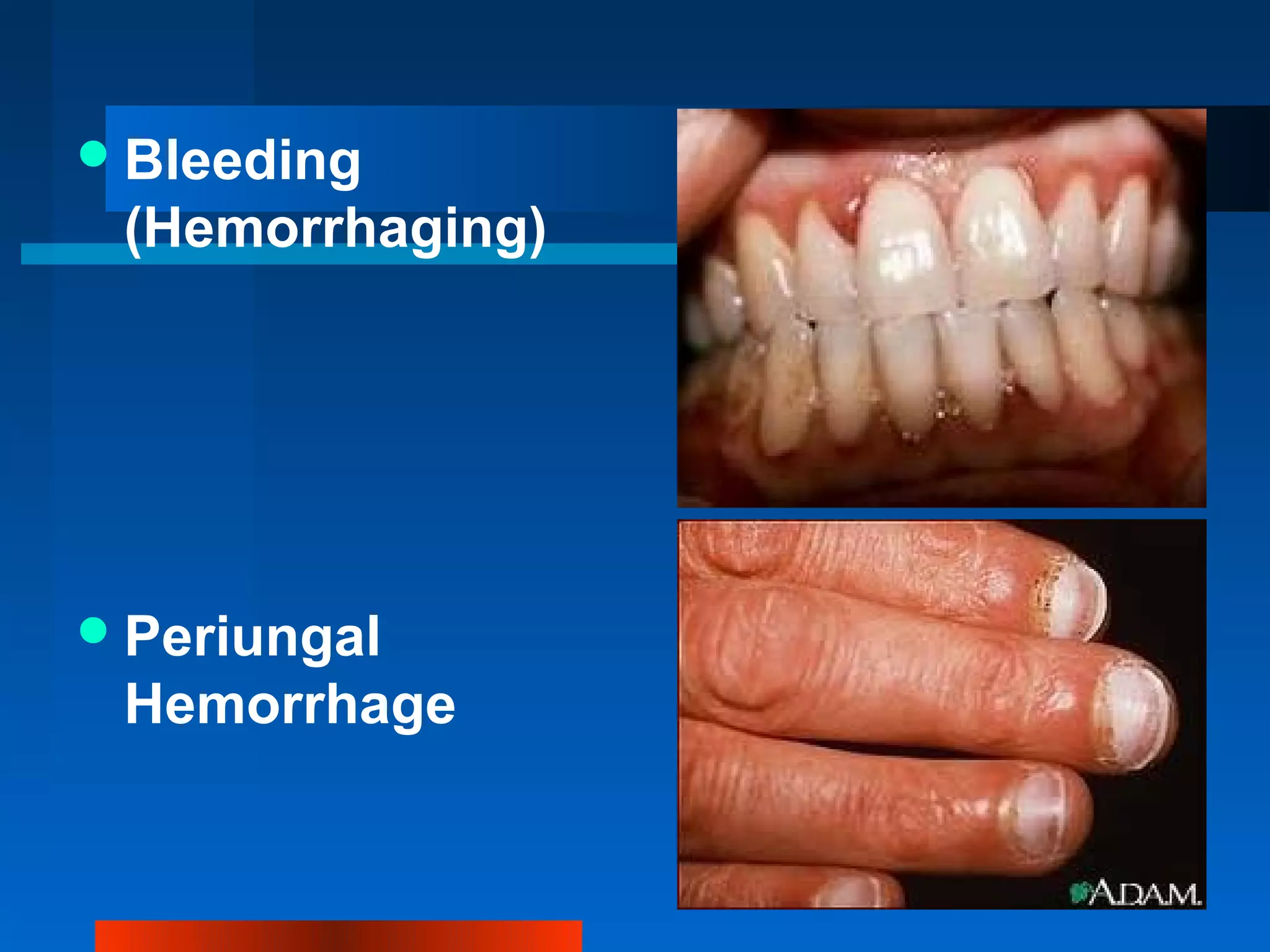 scurvy ~cabigas | PPT | Nutrition | Healthy Living
