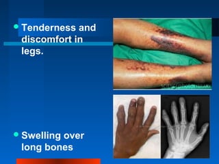 scurvy ~cabigas | PPT | Nutrition | Healthy Living