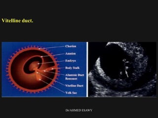 Vitelline Duct Ultrasound