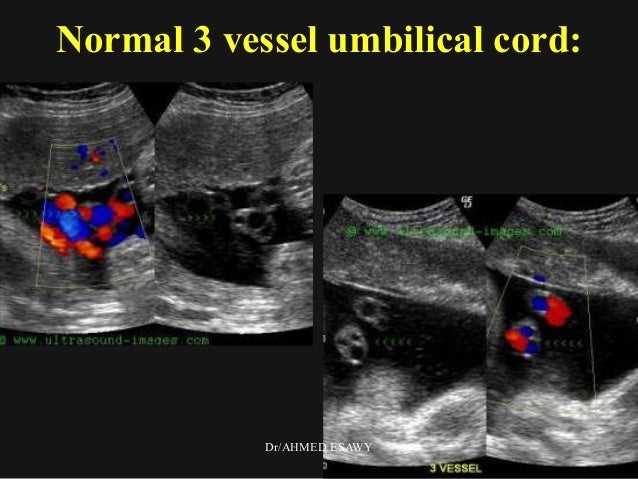 13-umblical cord imaging Dr Ahmed Esawy