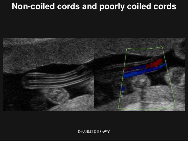 13-umblical cord imaging Dr Ahmed Esawy