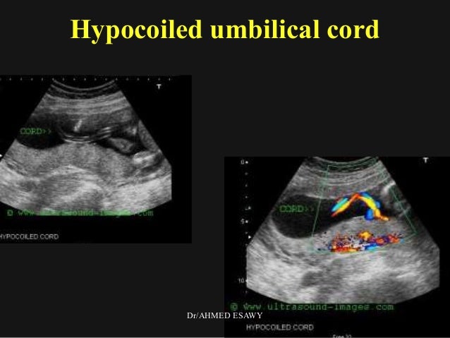 13-umblical cord imaging Dr Ahmed Esawy