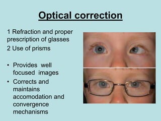 130335154-Non-Surgical-Management-of-squint.ppt