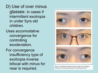 130335154-Non-Surgical-Management-of-squint.ppt