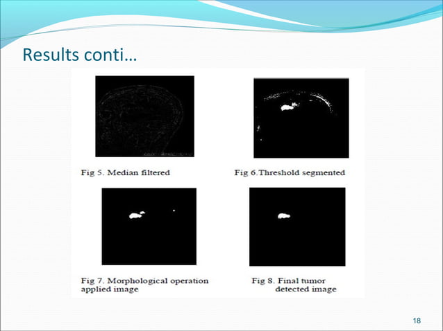 brain tumor detection by thresholding approach | PPT | Free Download