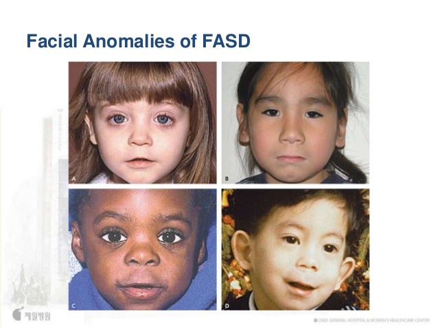 Fetal Alcohol Spectrum Disorder/ 정고운