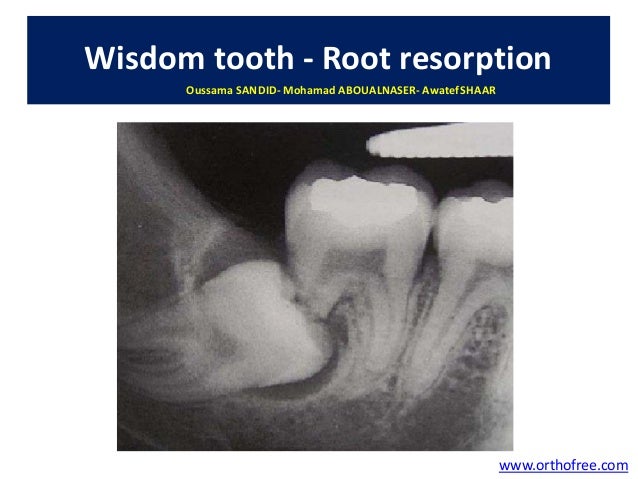 133 dental anomalies-mohamad aboualnaser-awatef shaar-orthodontist-or…