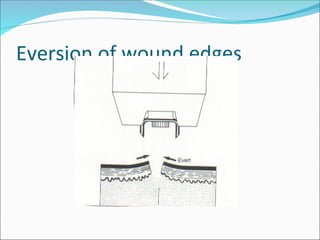 Wound management of trauma for medicals2.ppt