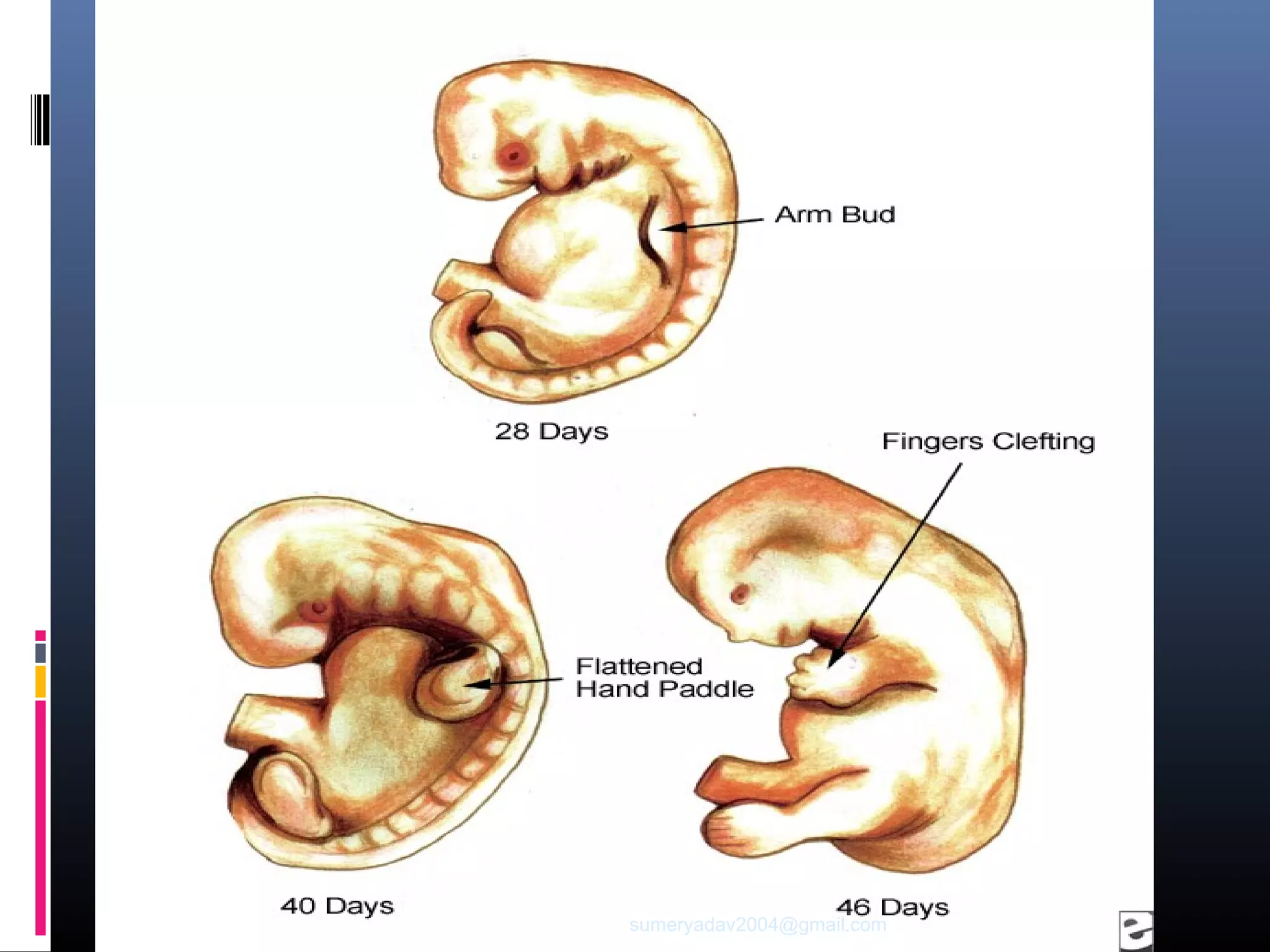 common congenital deformities of hand | PPT