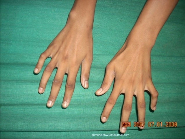 common congenital deformities of hand