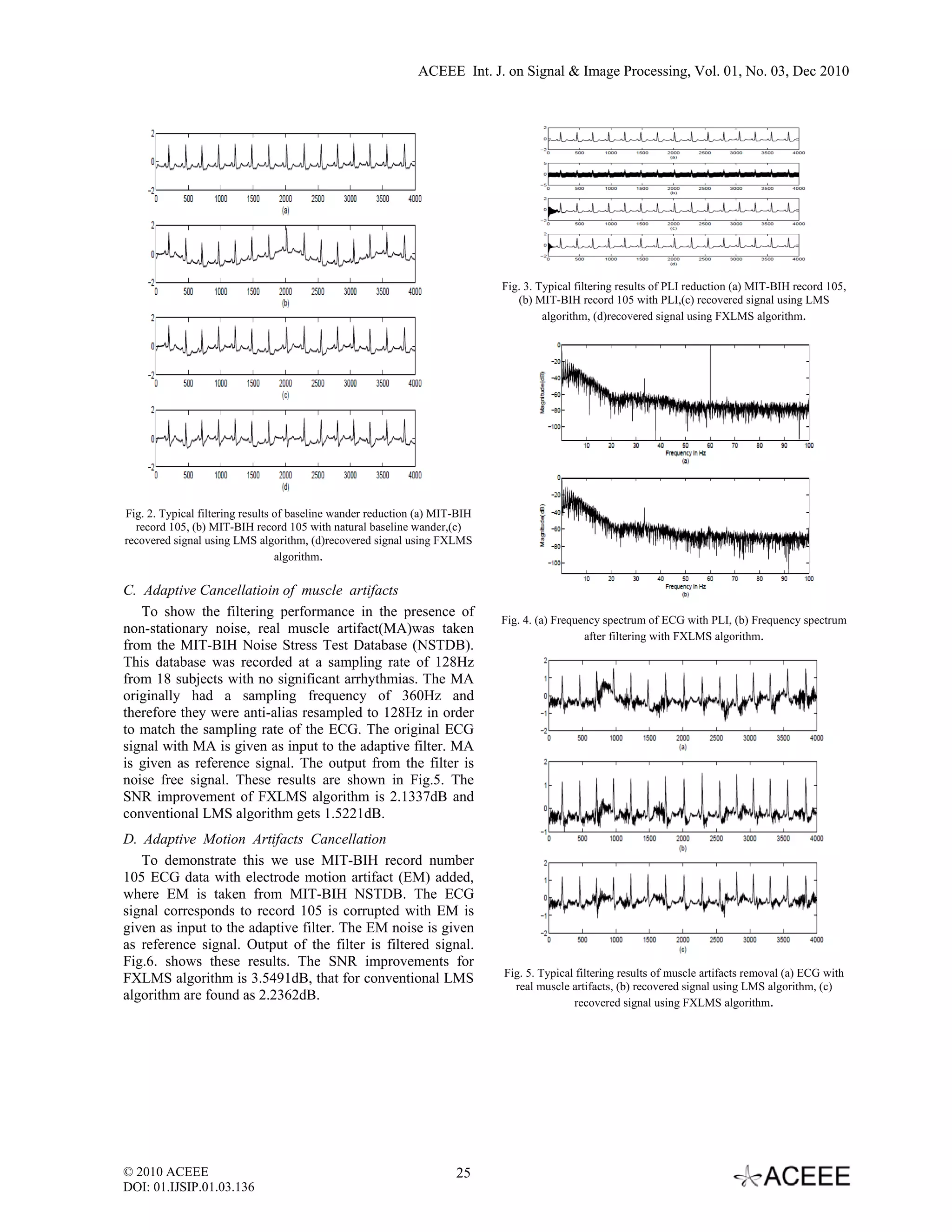 Filtering Electrocardiographic Signals Using Filtered X Lms Algorithm Pdf 