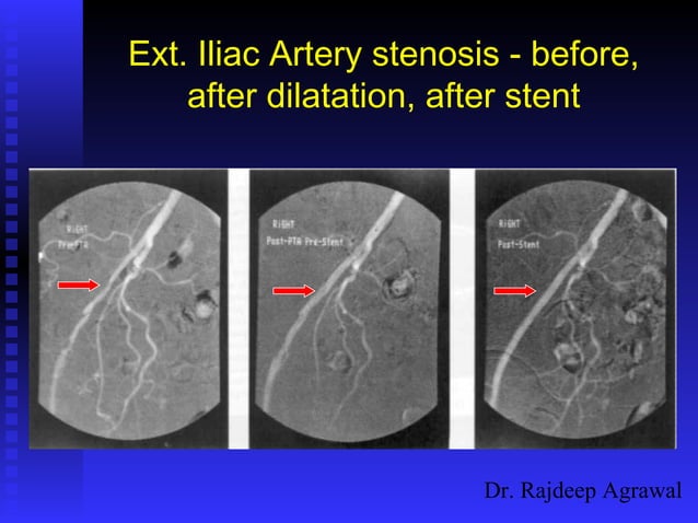 1362466145 pad, agiography & angioplasty | PPT | Blood Disorders ...