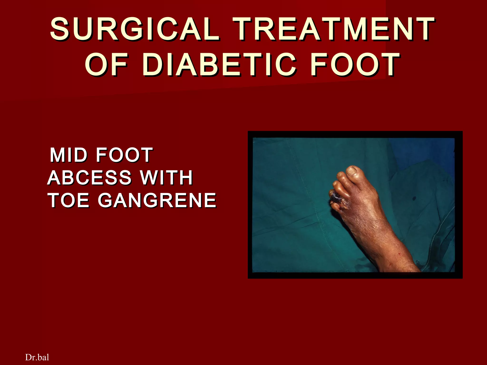 1362562807 surgical anatomy of diabetic foot | PPT