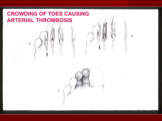 1362562807 surgical anatomy of diabetic foot | PPT
