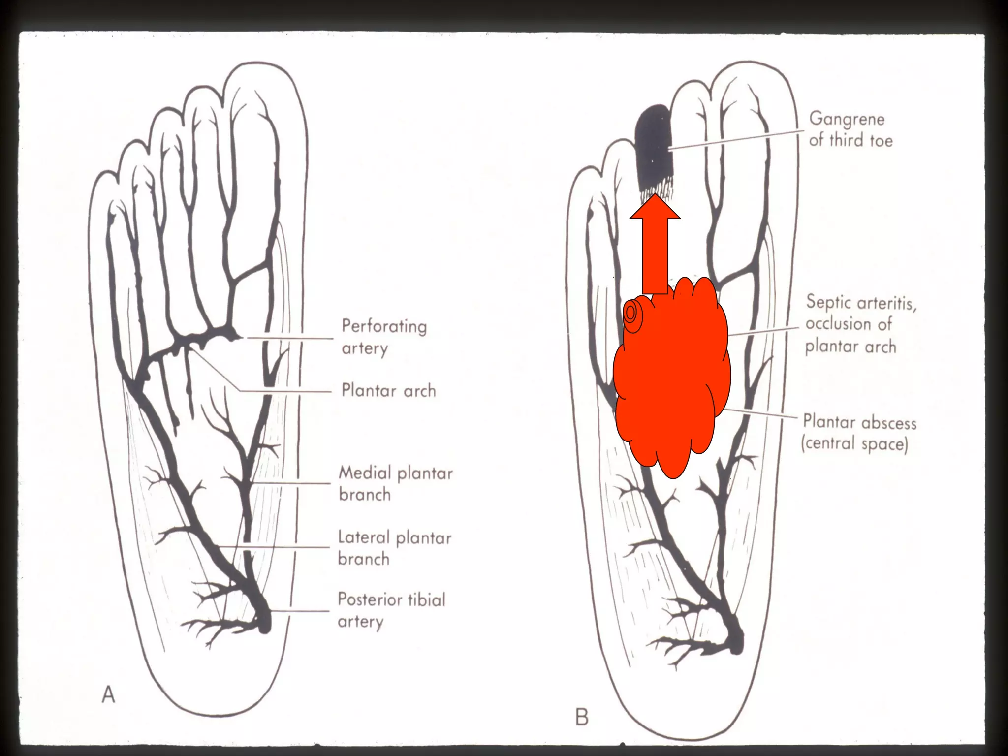 1362564096 anatomy and spread of foot infections | PPT