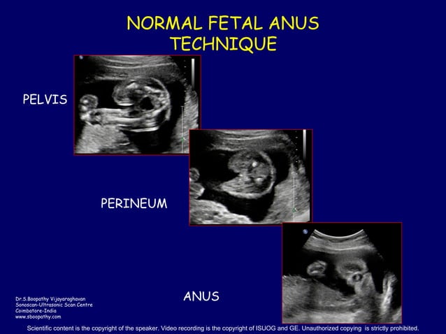 Fetal Anus Sonographic Visualisation - Dr.S.Boopathy Vijayaraghavan | PPT