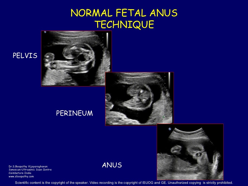 Fetal Anus Sonographic Visualisation - Dr.S.Boopathy Vijayaraghavan