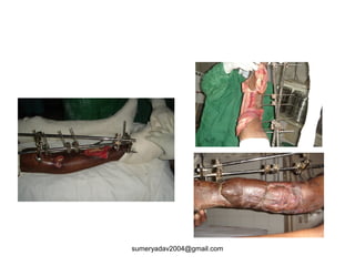 gastrocnemius flap | PPT