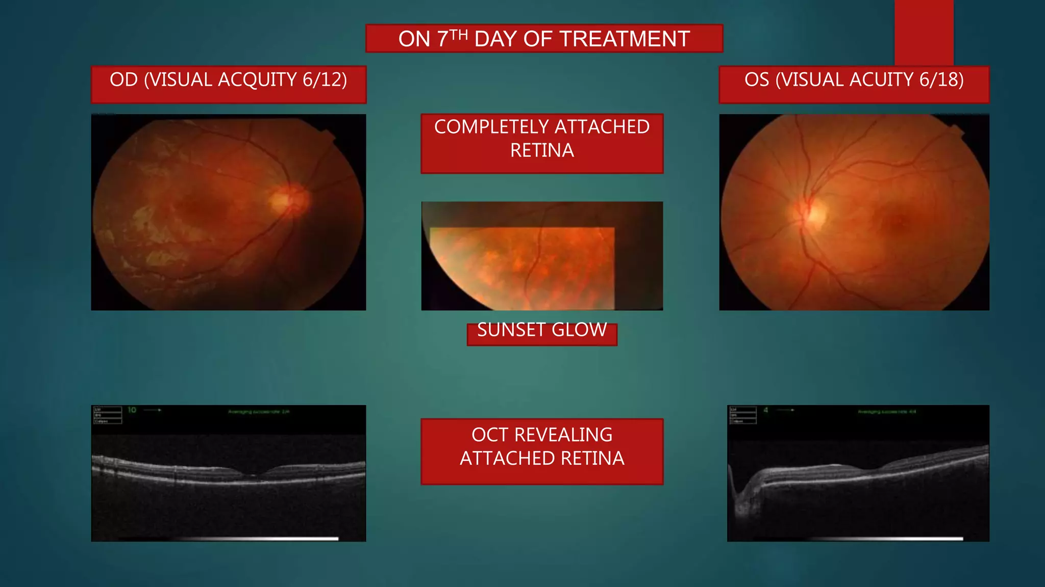 A Case Of Bilateral Exudative Retinal Detachment | PPT