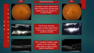 A Case Of Bilateral Exudative Retinal Detachment | PPT