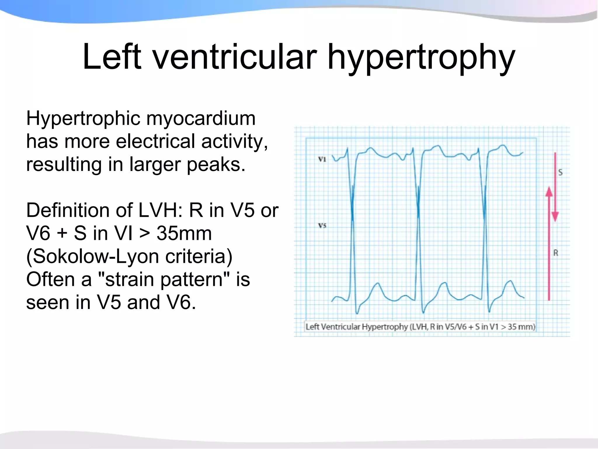 ECGpedia - ECG Presentation | PPT