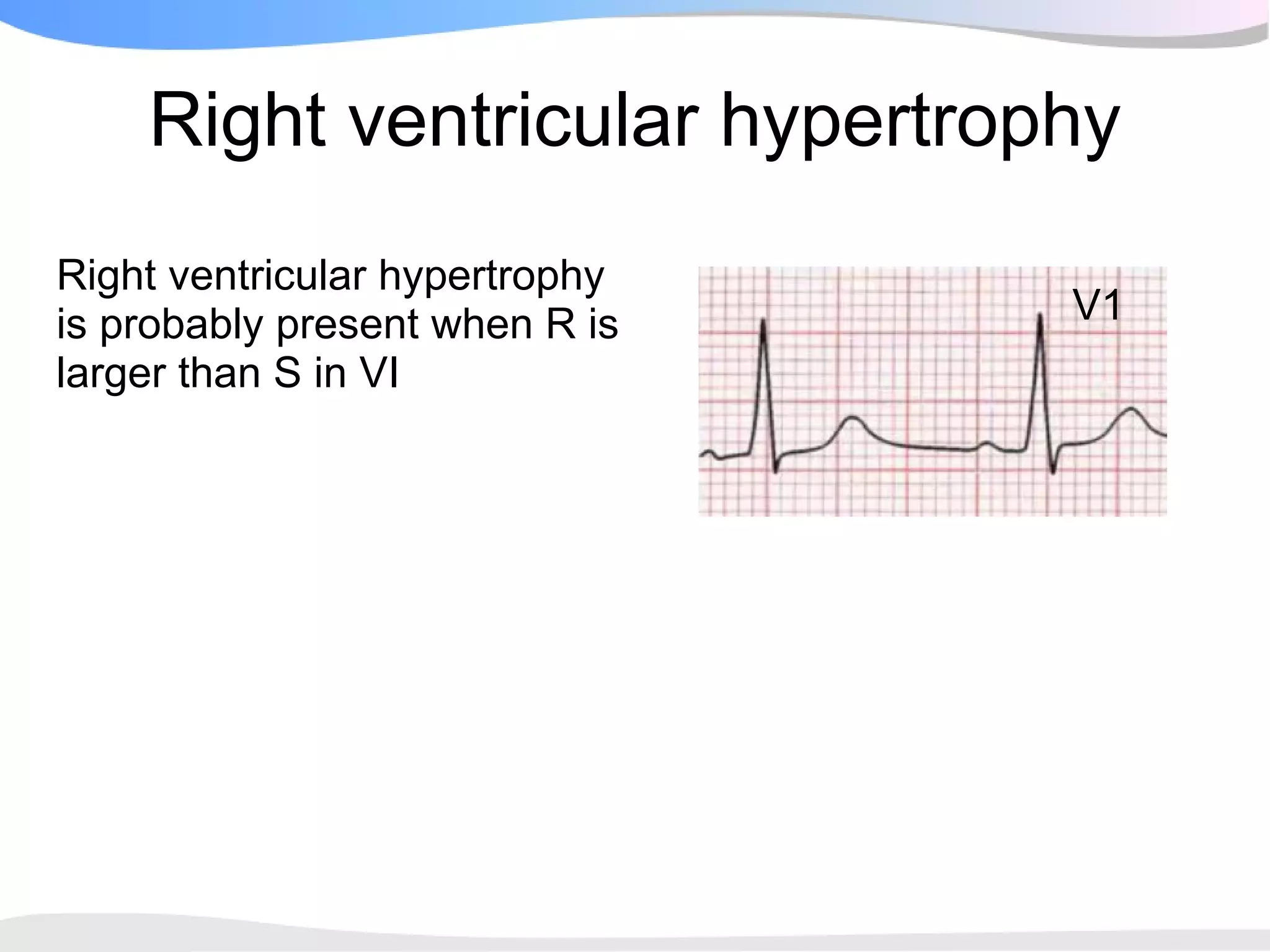 ECGpedia - ECG Presentation | PPT