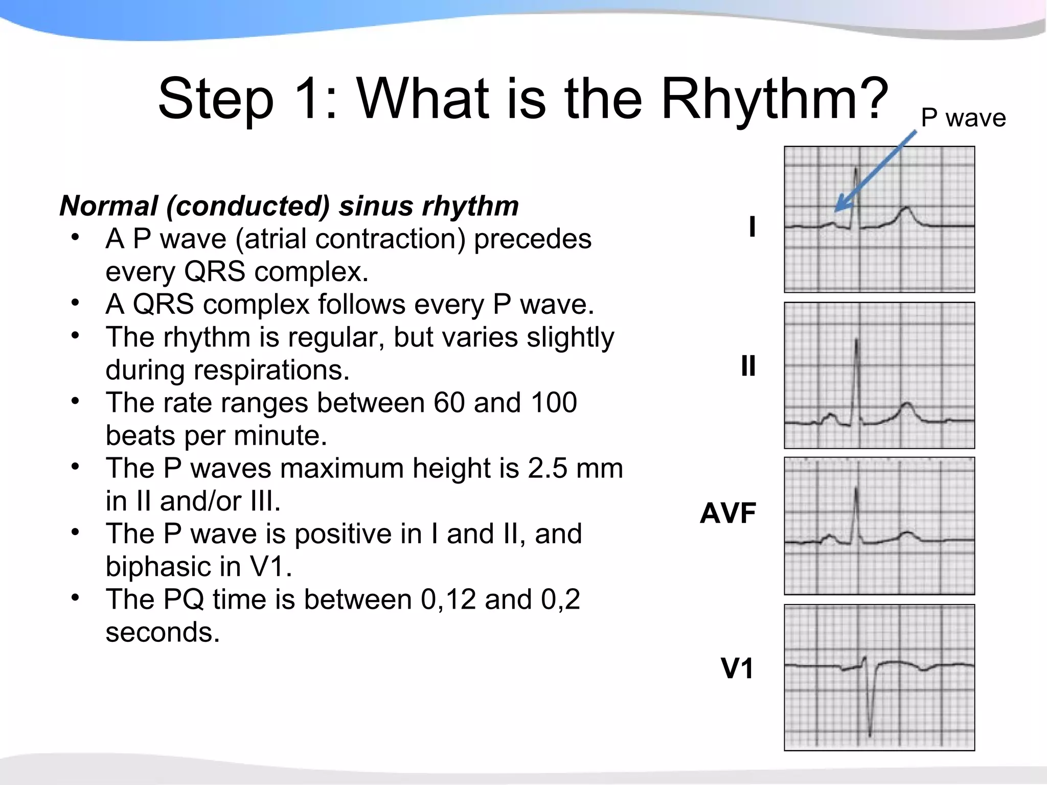 ECGpedia - ECG Presentation | PPT