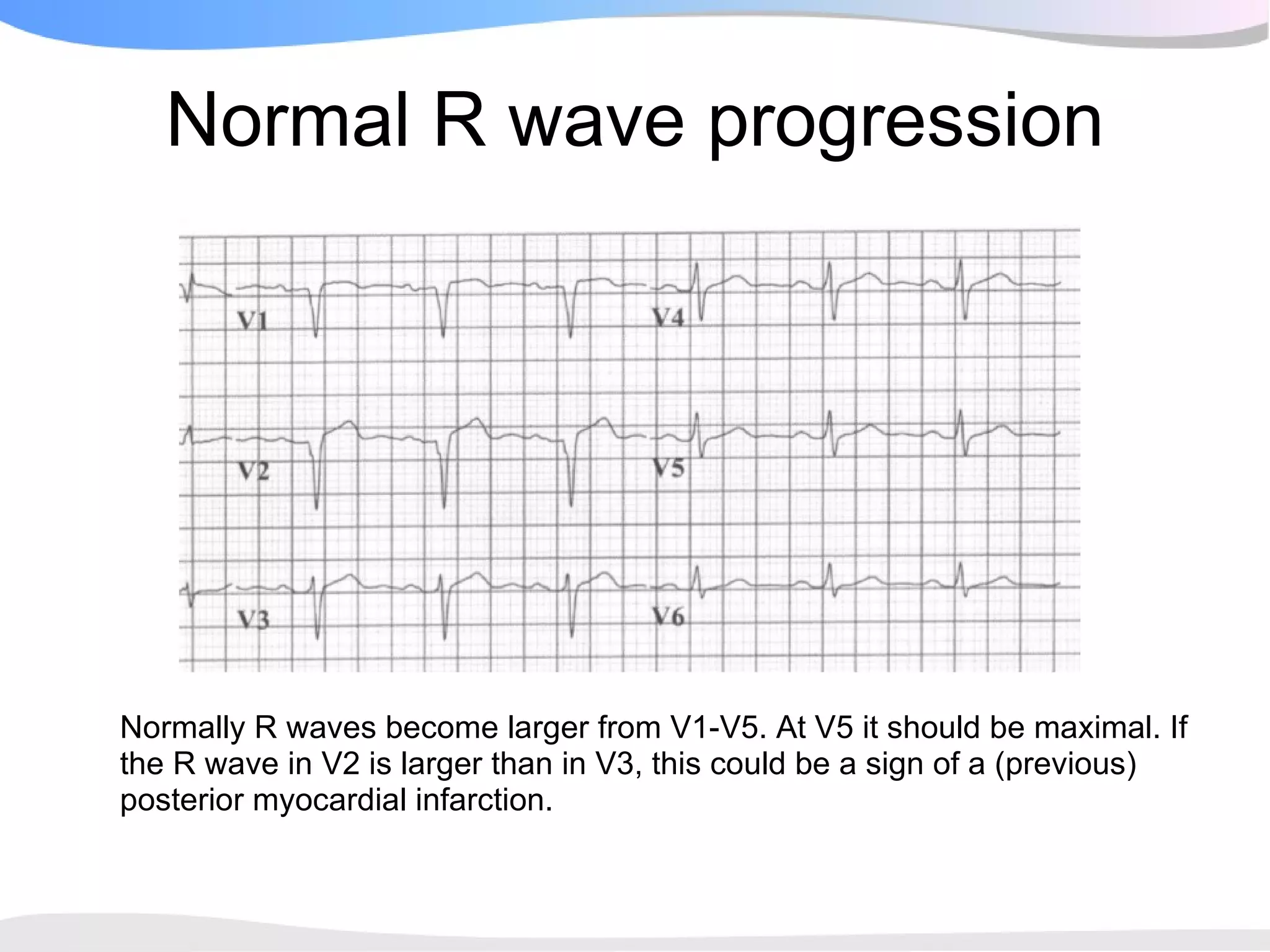 ECGpedia - ECG Presentation | PPT
