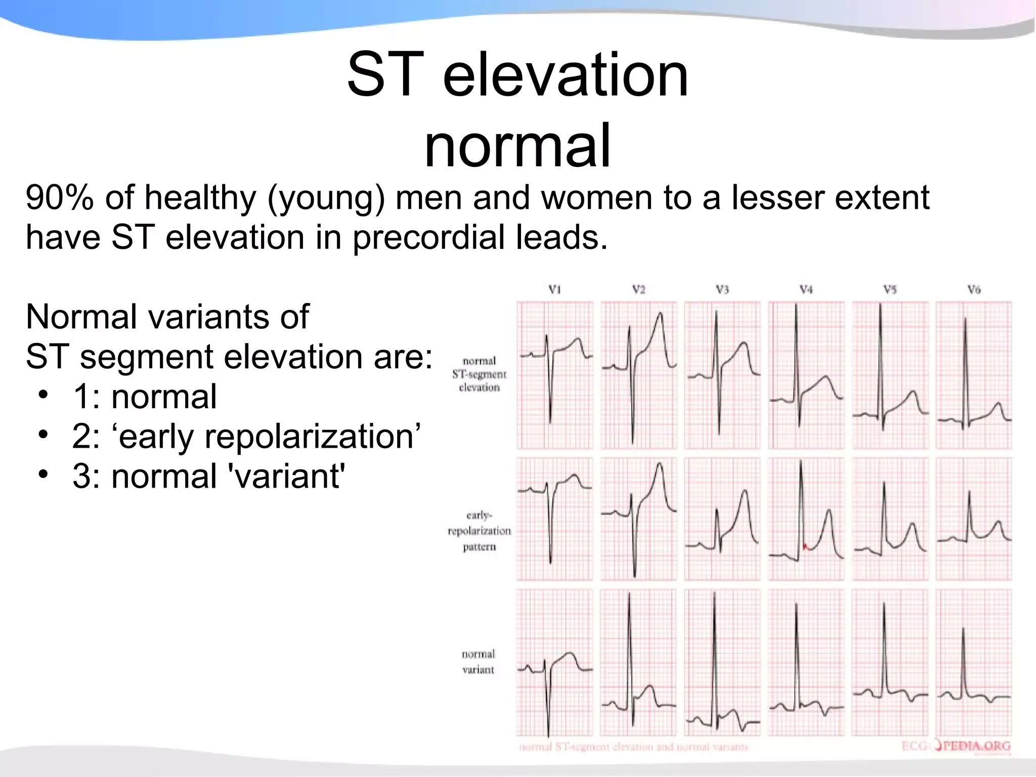 ECGpedia - ECG Presentation | PPT