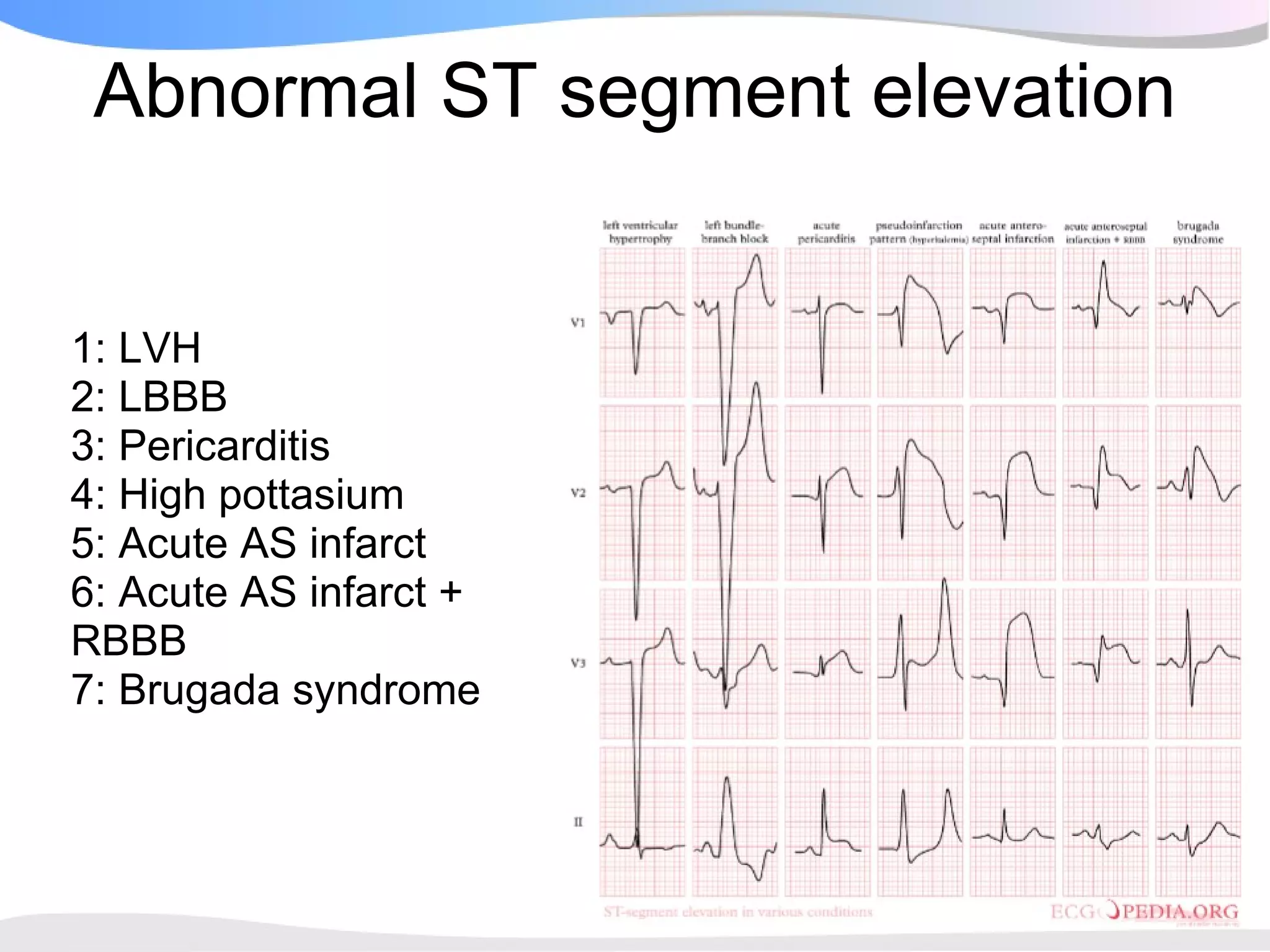 ECGpedia - ECG Presentation | PPT