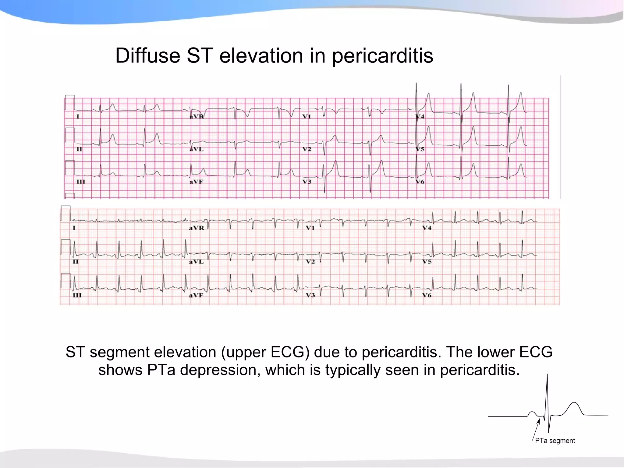 ECGpedia - ECG Presentation | PPT