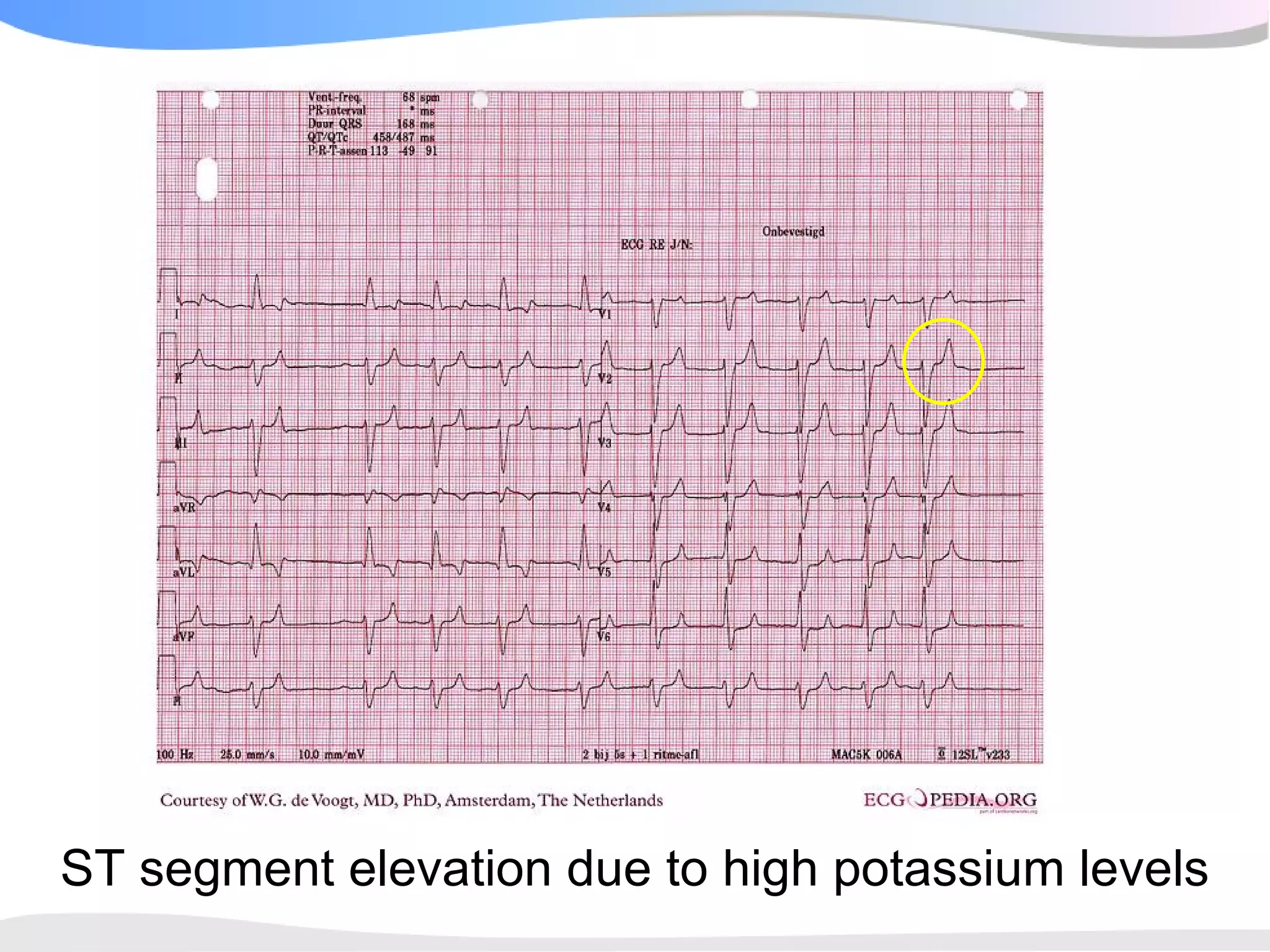 ECGpedia - ECG Presentation | PPT