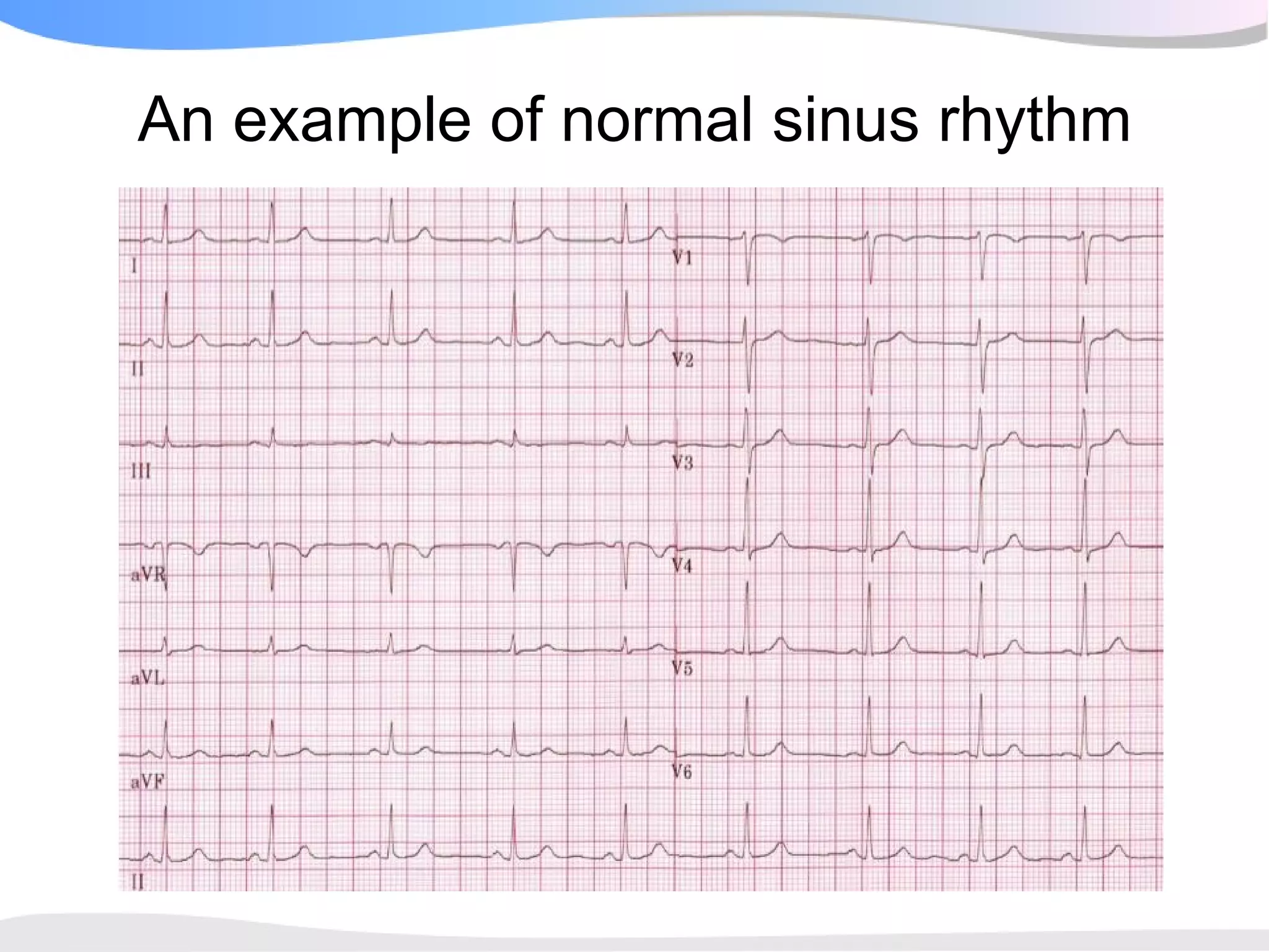 ECGpedia - ECG Presentation | PPT