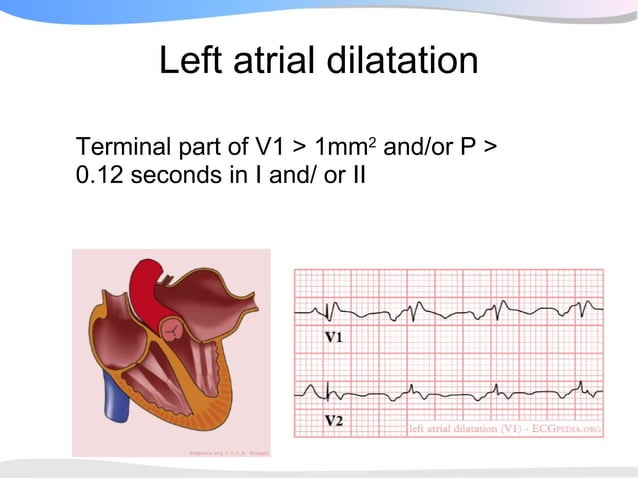 ECGpedia - ECG Presentation | PPT