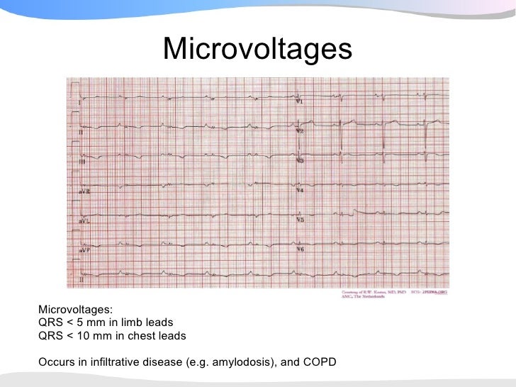 ECGpedia - ECG Presentation