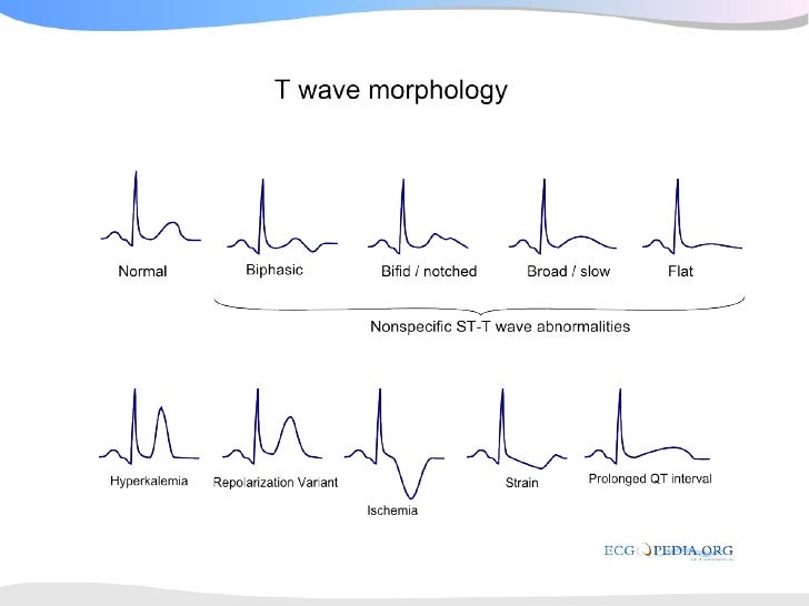 ECGpedia - ECG Presentation