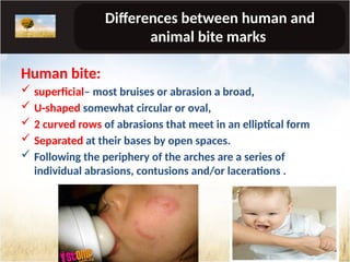 BITE MARKS IN FORENSIC ODONTOLOGY AND INVESTIGATIONS | PPT