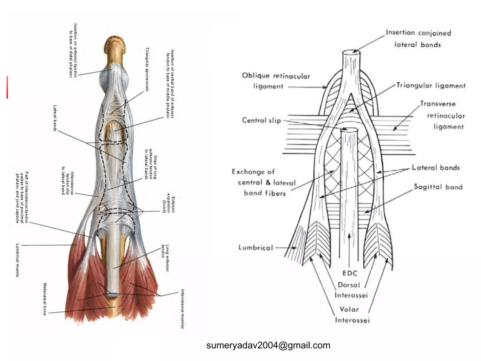 extensor tendons injury and deformity | PPT