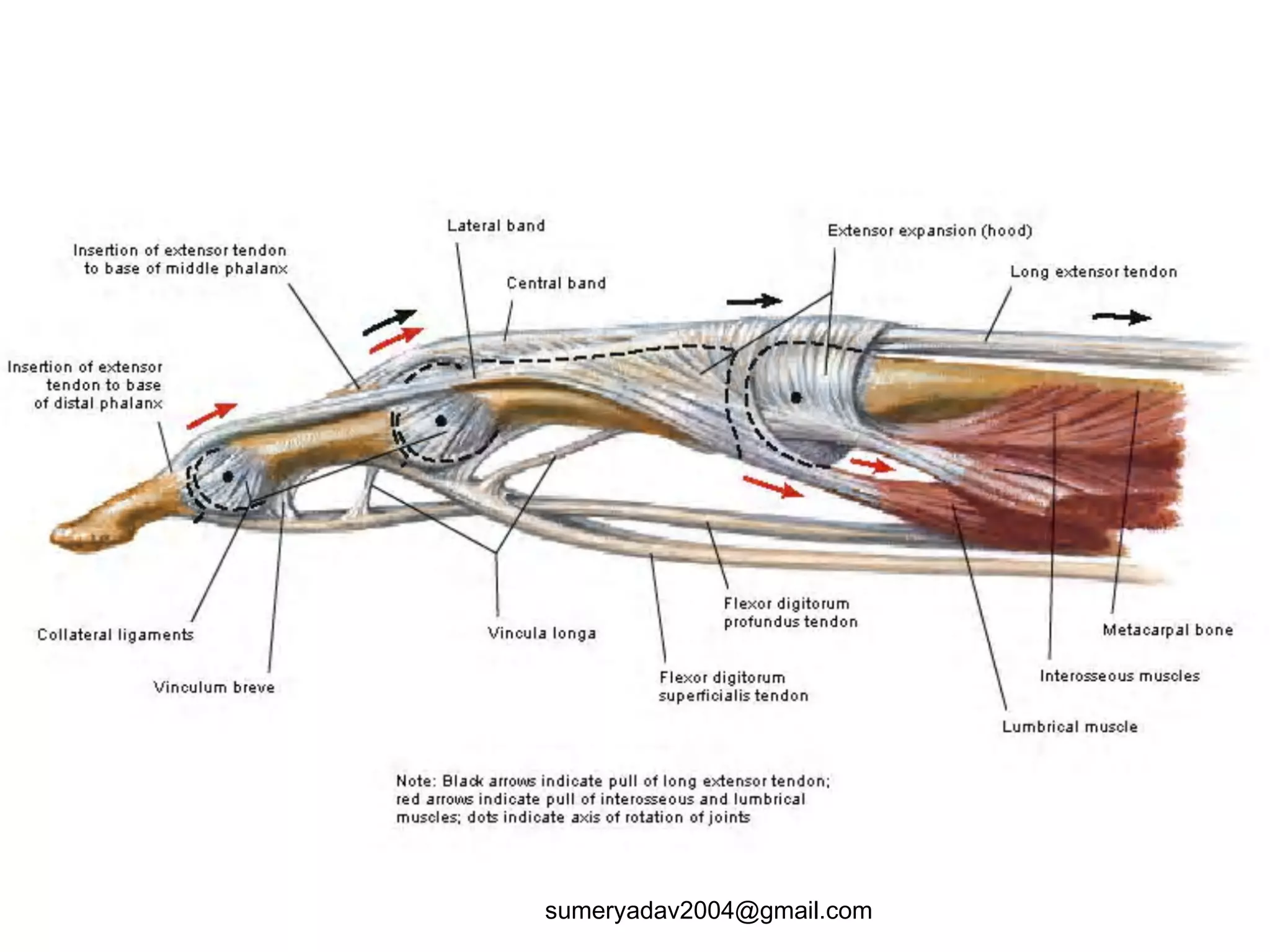 extensor tendons injury and deformity | PPT