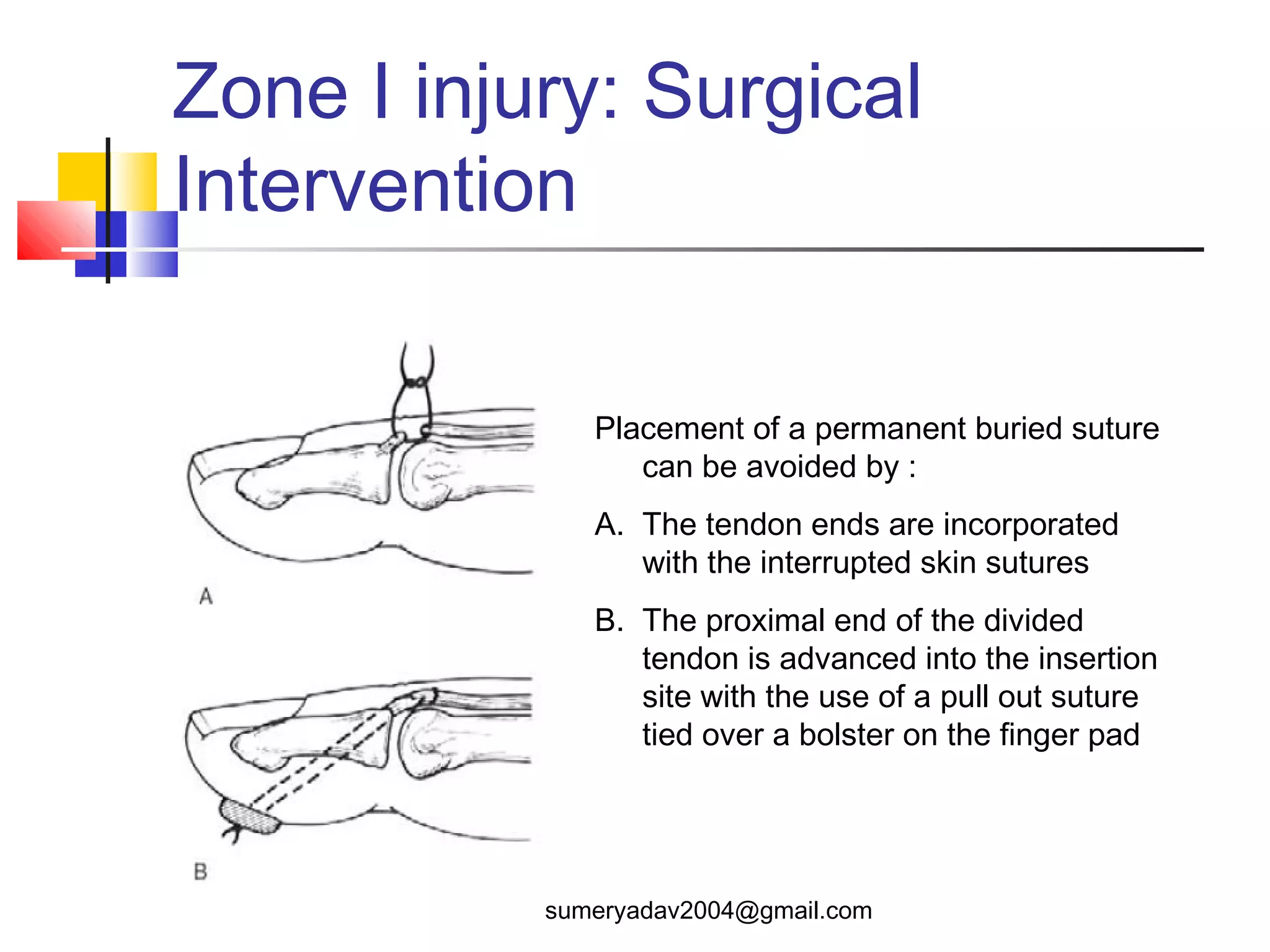 extensor tendons injury and deformity | PPT
