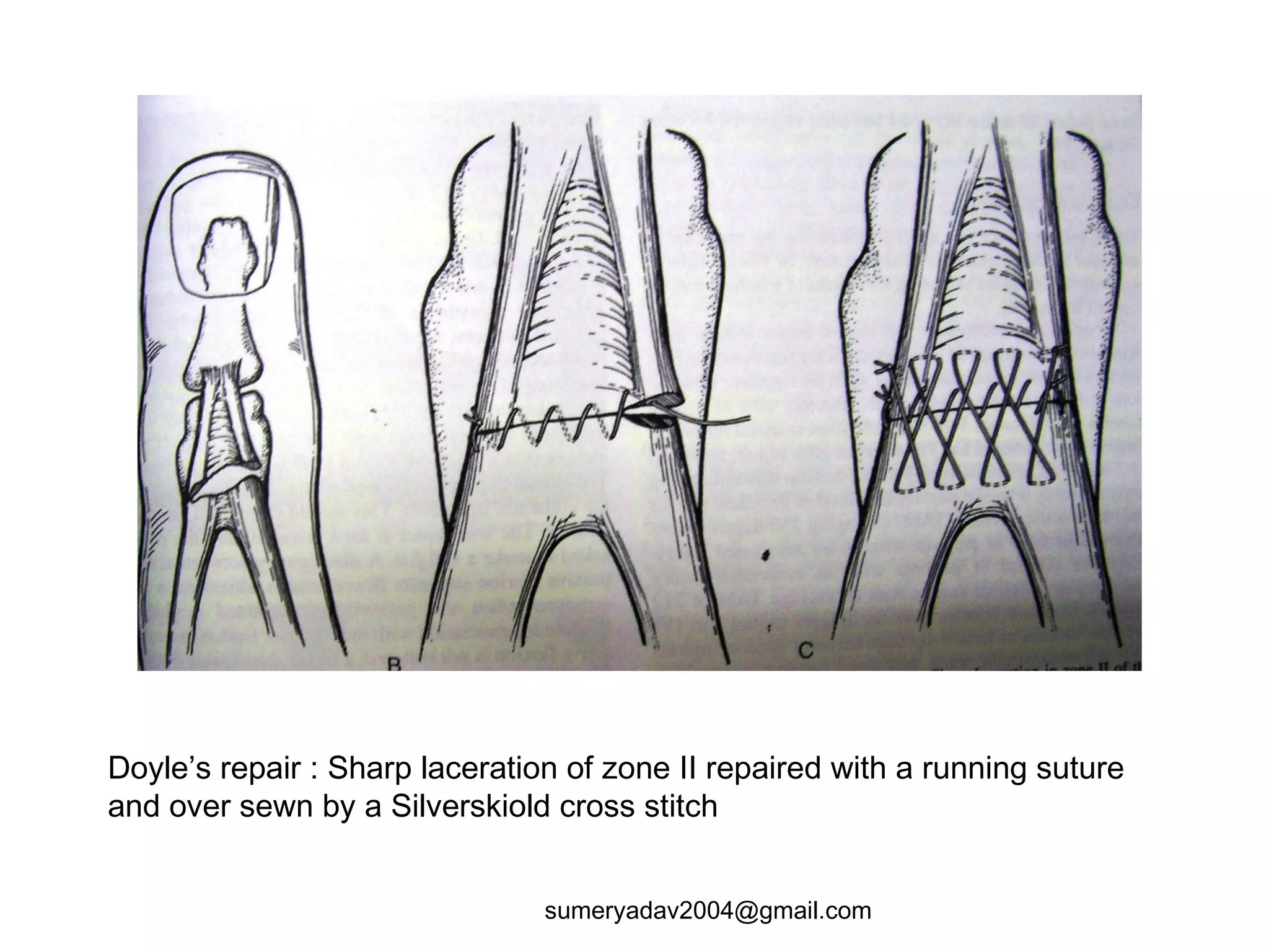 extensor tendons injury and deformity | PPT