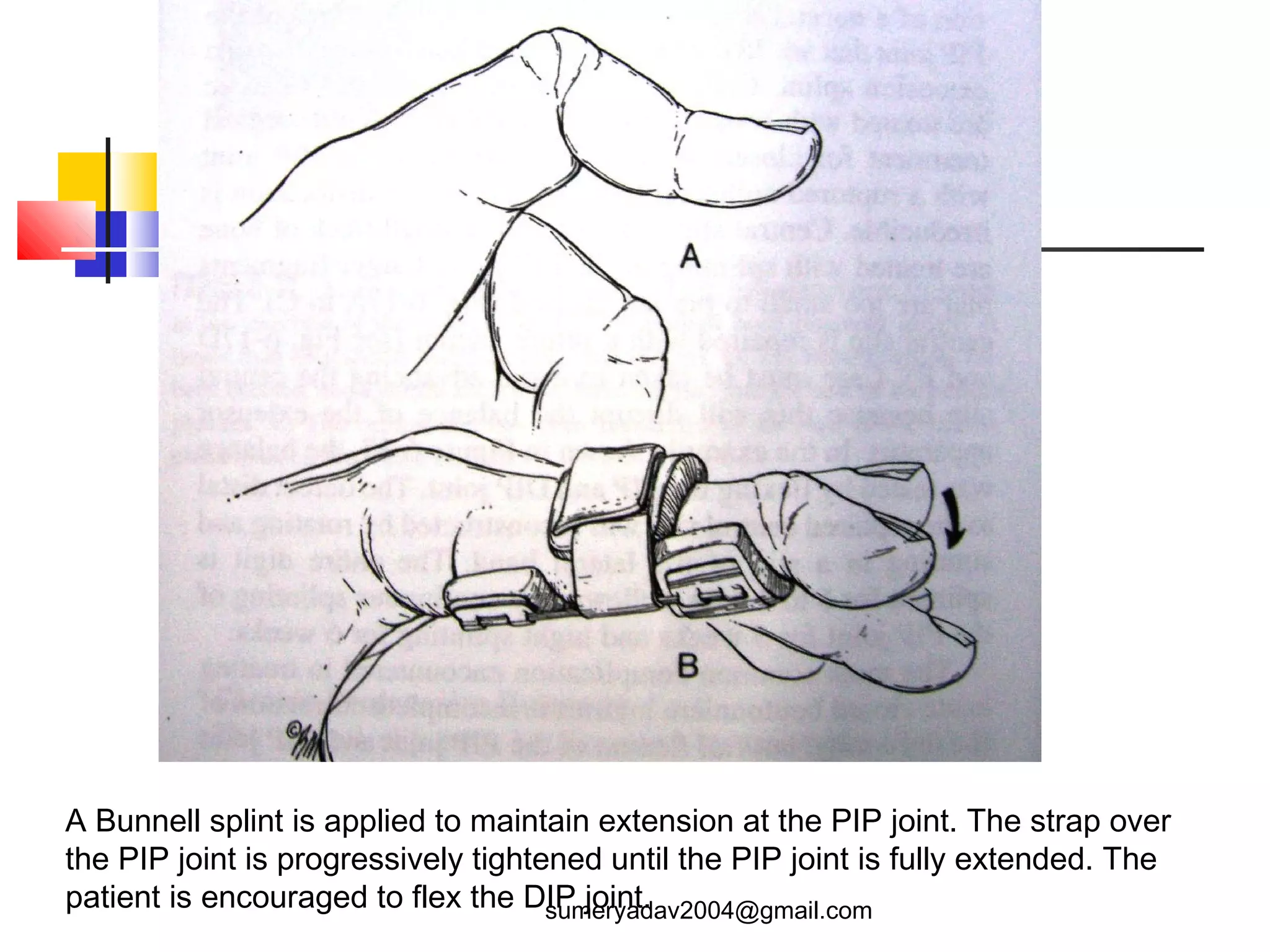 extensor tendons injury and deformity | PPT
