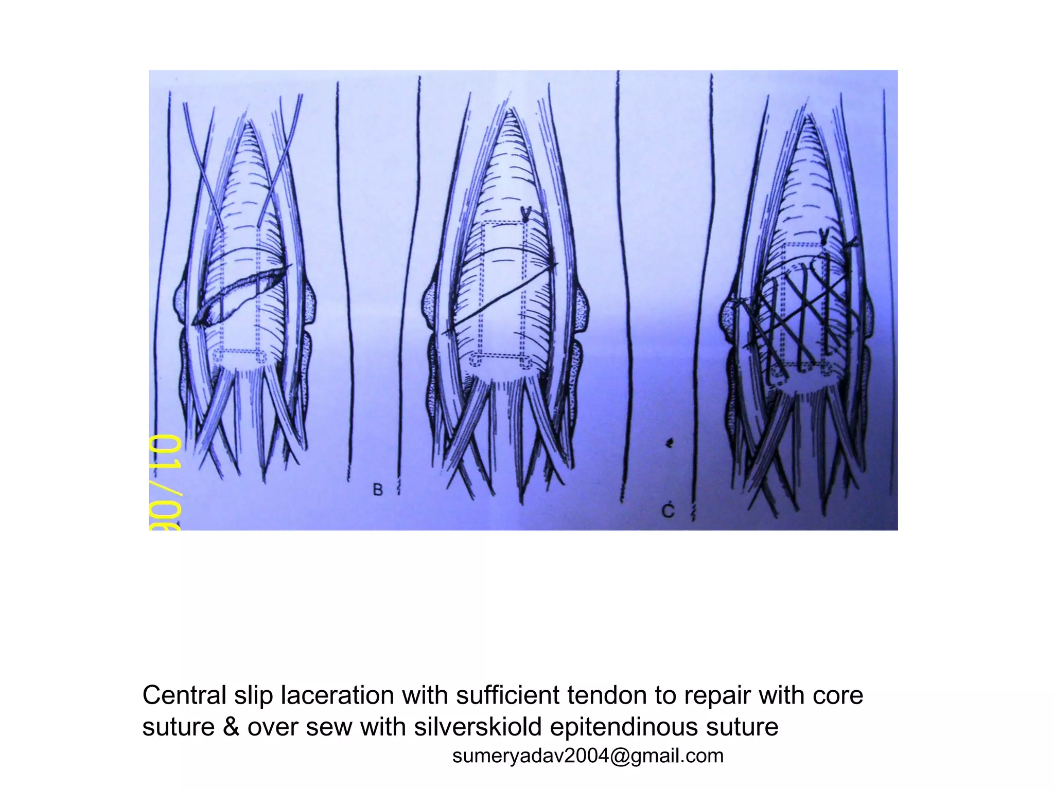 extensor tendons injury and deformity | PPT