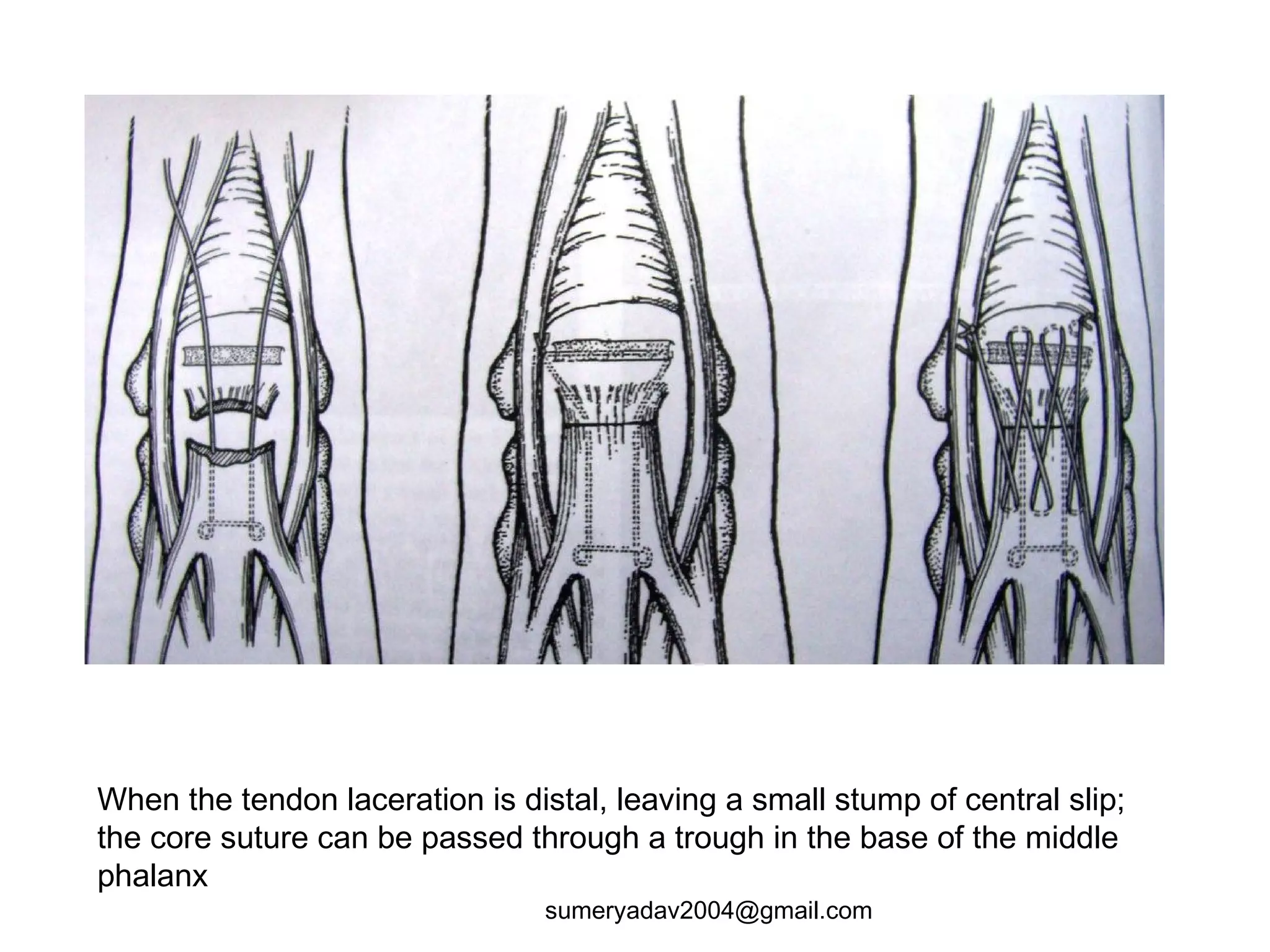 extensor tendons injury and deformity | PPT