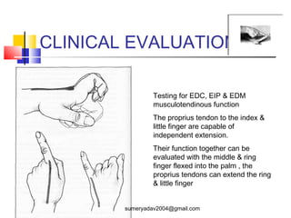 extensor tendons injury and deformity | PPT
